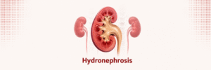 Hydronephrosis - Ainu